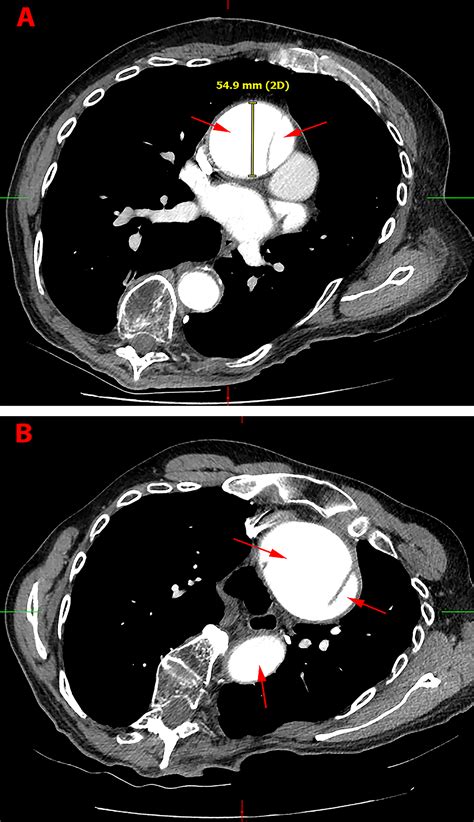 Cor Knot Automated Fastener In Distal Anastomosis Of Total Aortic Arch