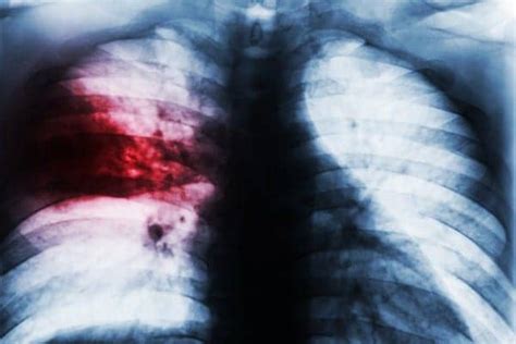Rsna Announces Pneumonia Detection Machine Learning Challenge Axis Imaging News