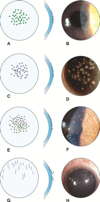 Punctate Epithelial Erosions Pee Secondary To Exposure