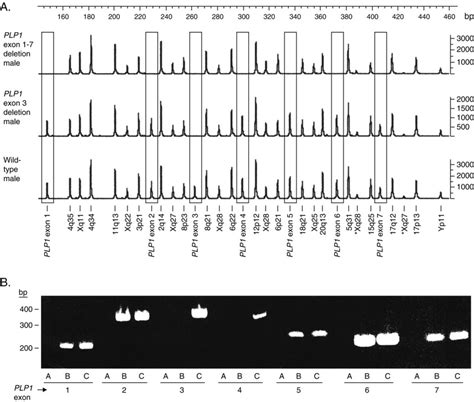 Mlpa Analysis Of Samples Showing Deletions Download Scientific Diagram