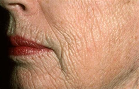 What Is Solar Elastosis
