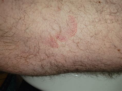 Odd Rash Pattern R Dermatologyquestions