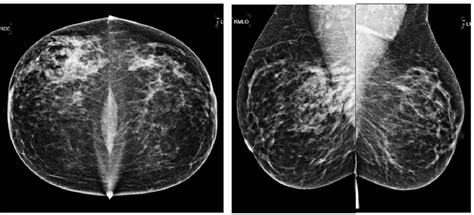 Figure 1 From Hallazgos Ecográficos En El Carcinoma Ductal In Situ