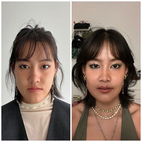 1 Month Post Op With Pics Double Jaw Surgery For Underbite No