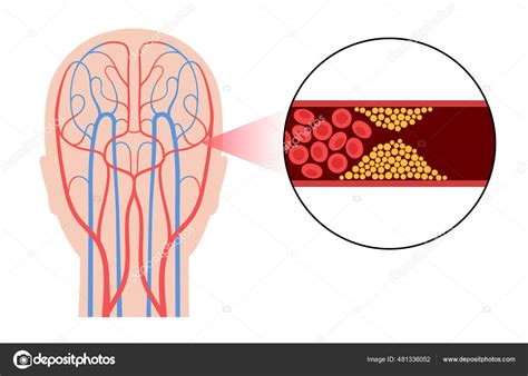 Brain Stroke Ishemic Stock Vector By ©pikovit 481336052