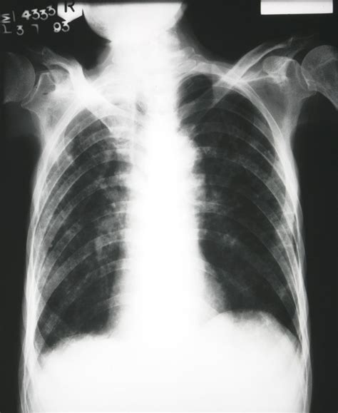 B Chest Radiograph On 3 7 1993 Showing Miliary Nodules Download