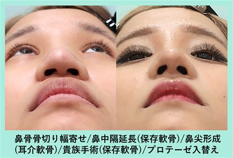 完全クローズド法で、鼻中隔延長、鼻骨骨切り、貴族手術などのハイテク鼻フル整形 東京・銀座の美容外科クリニック｜wom Clinic Ginza