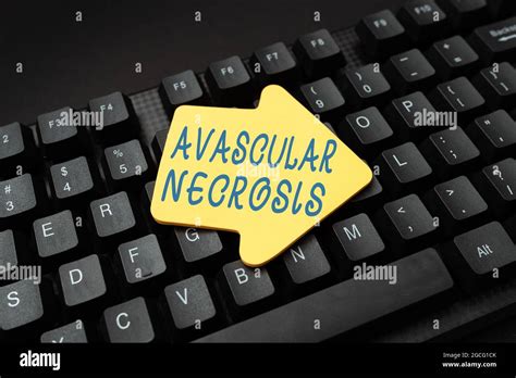 Sign Displaying Avascular Necrosis Business Overview Death Of Bone