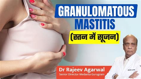 Granulomatous Mastitis