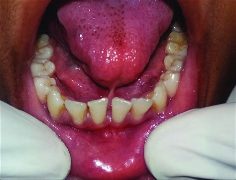 Preoperative Clinical Picture Showing Ankyloglossia Download