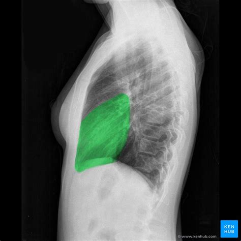 Normal Chest X Ray Anatomy Tutorial Kenhub