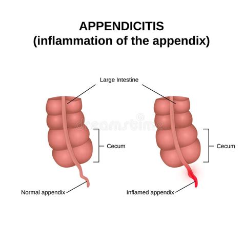 Inflammation Of The Appendix Stock Vector Illustration Of Abdominal Blockage