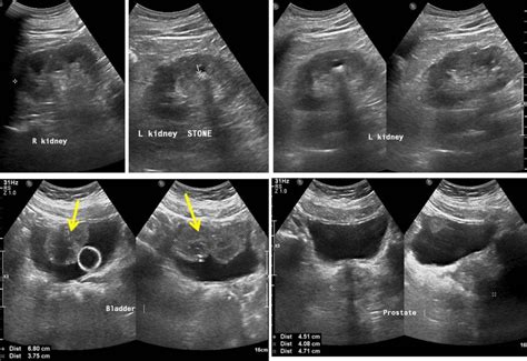 Synchronous Urinary Bladder And Prostate Cancer Radiology Cases