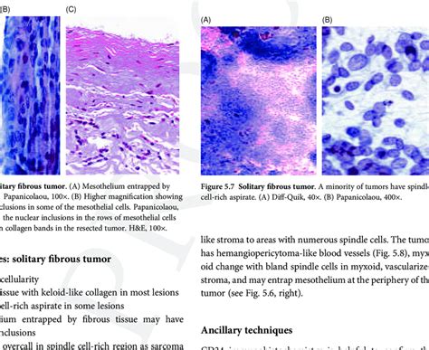 5 Solitary Fibrous Tumor Majority Of The Tumors Show Keloid Like