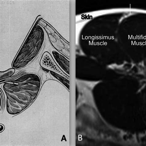 Mean Locations Of Multifi Dus Longissimus Intermuscular Cleavage Planes