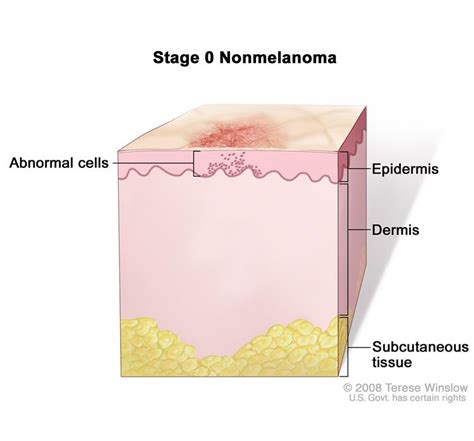 Stage 0 Nonmelanoma Skin Carcinoma In Situ Drawing Shows Skin Anatomy