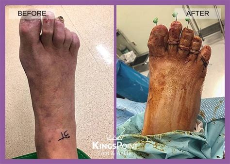 Hammer Toe Before And After