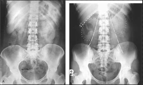 Psoas Sign X Ray