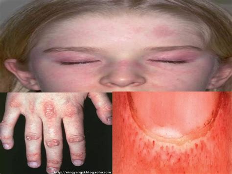 Polymyositis Ppt
