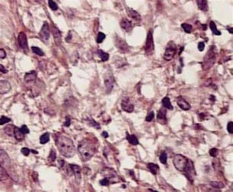 Epithelioid Histiocytes And Lymphocytes Download Scientific Diagram