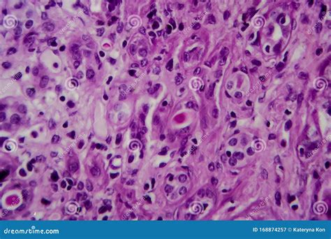 Chronic Glomerulonephritis Light Micrograph Stock Image Image Of Histology Cell 168874257