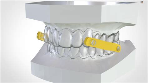 3d Printed Digital Elastic Mandibular Advancement Appliance By Labmagic