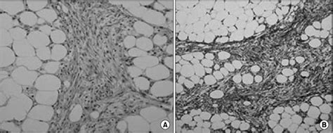 Mesenteric Biopsy Showed Nodular Panniculitis Septal Fibrosis With Download Scientific Diagram