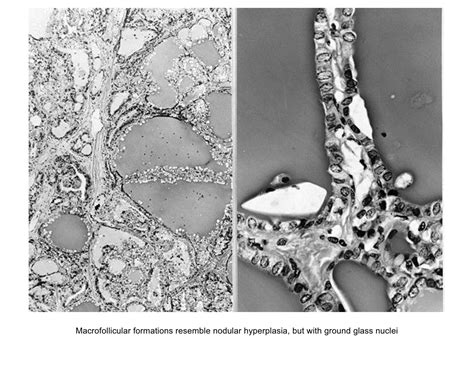Pathology Outlines Follicular