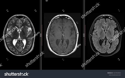 정상적인 두뇌의 자기공명영상 스톡 사진 1657054954 Shutterstock