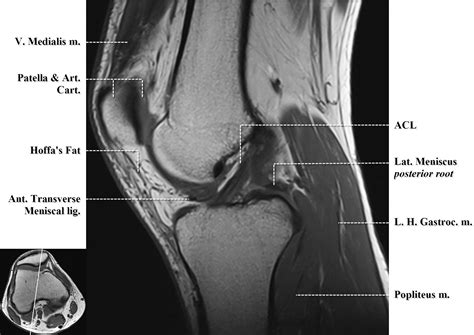Normal Mr Imaging Anatomy Of The Knee Magnetic Resonance Imaging Clinics