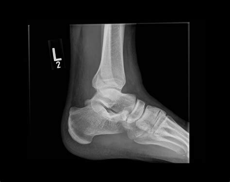 Trans Syndesmotic Fibular Fractures Lance M Mabry 2 Updates 2