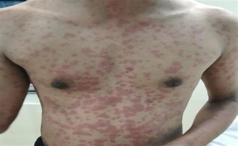 Multiple Discrete And Confluent Erythematous Edematous Papules And
