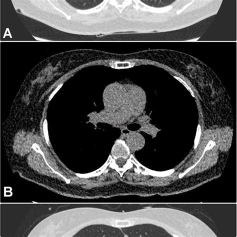 An Example Of Subsolid Nodule With An Air Bronchogram Sign According To Download Scientific