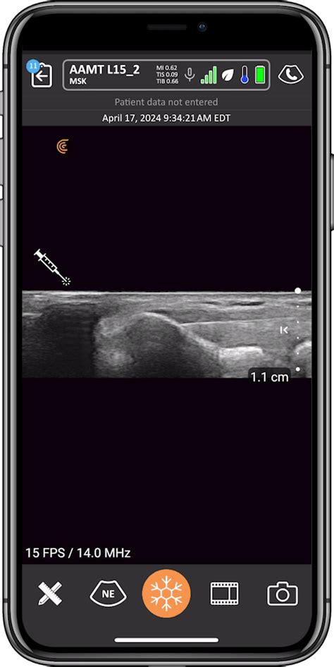 Ultrasound Guided Dry Needling Enhancing Precision And Outcomes Clarius