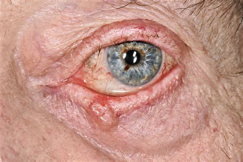 Basal Cell Carcinoma On Eyelid