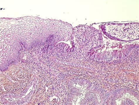Cervix Transformation Zone Histology