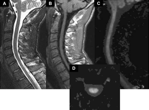 Figure 1 From Diffusion Weighted Imaging Diffusion Tensor Imaging And