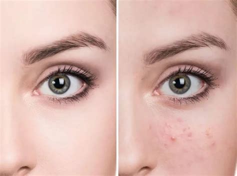 ဝက်ခြံ အမာရွတ်နဲ့ အရေးအကြောင်းတွေကိုဖယ်ရှားပေးမယ့် ဇာတိပ္ဖိုလ်သီး