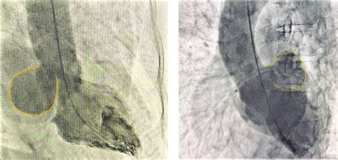 Large Saccular Aneurysm From Noncoronary Sinus In Rao 30 And Lao 50 20