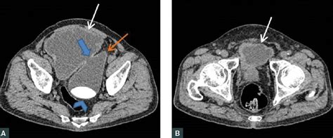 Racgp Case Of A Giant Urinary Bladder Diverticulum