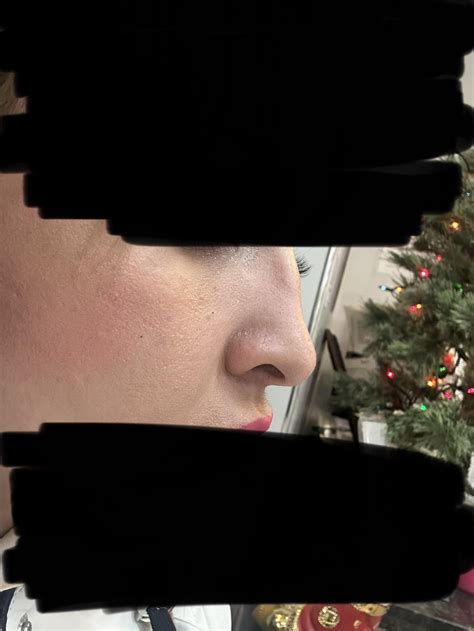 Bad Rhinoplasty 18 Months Post Op Rplasticsurgery
