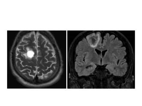 Tumefactive Demyelination Pptx