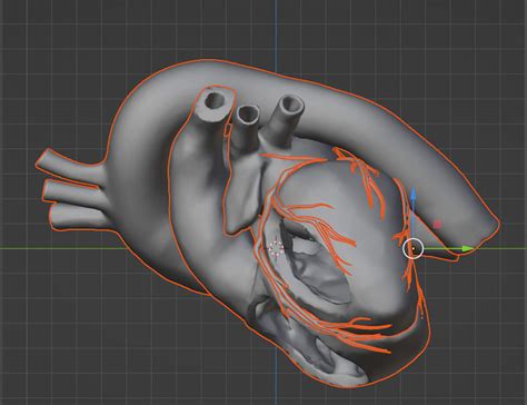 3d Model Of Partial Anomalous Pulmonary Venous Connection By Azekapeka