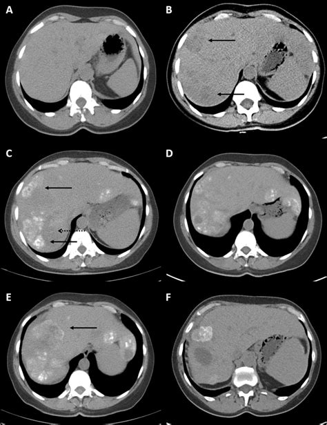 Radiological Progression Of Liver Metastases By Unenhanced Ct A Download Scientific Diagram