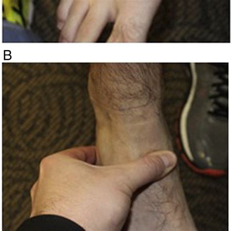 Pdf Modified Coaptation Splint With Sugar Tong Intrinsic Plus