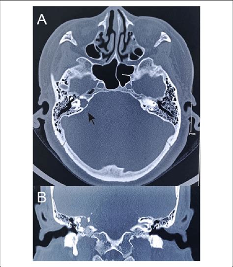 High Resolution Computed Tomography Hrct 1 Mm Section Bone