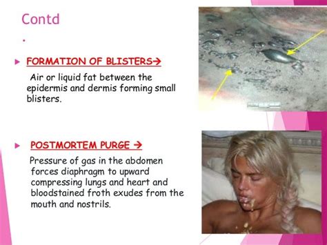 Forensic Medicene Putrefaction