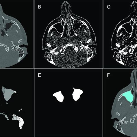 Tool For Automated Maxillary Sinus Segmentation A Original Image