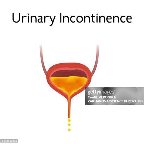 89 Urinary Incontinence Illustration High Res Illustrations Getty Images