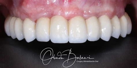 Mejorando La Sonrisa Implante Dental Por Elevaci N De Seno Blog